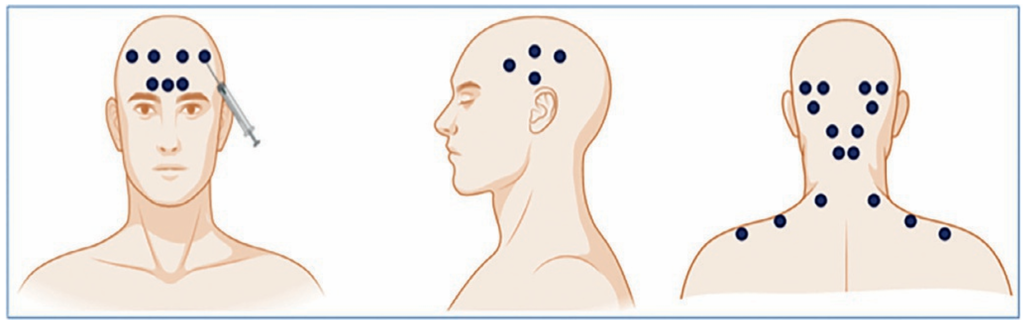 OnabotulinumtoxinaA (Botox®) no tratamento da enxaqueca crônica ...